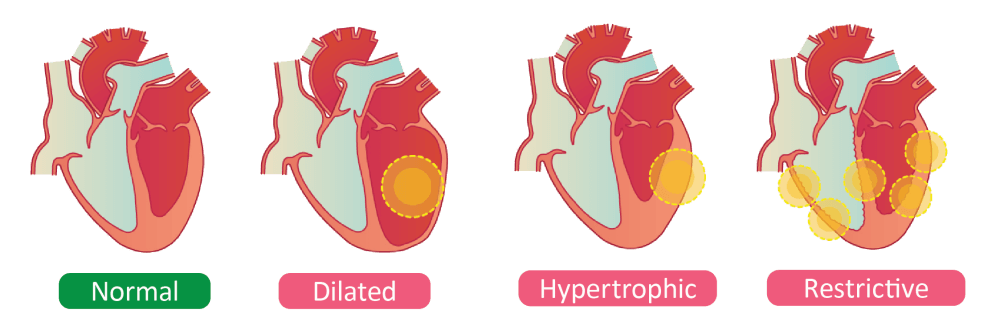 Pangenia Lifesciences - MYGENIA® Inherited Cardiac Disease Genetic ...